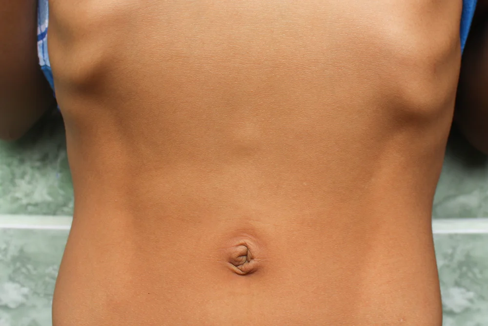 Hérnia Inguinal, Umbilical e Epigástrica: Tipos, Sintomas e Quando Operar